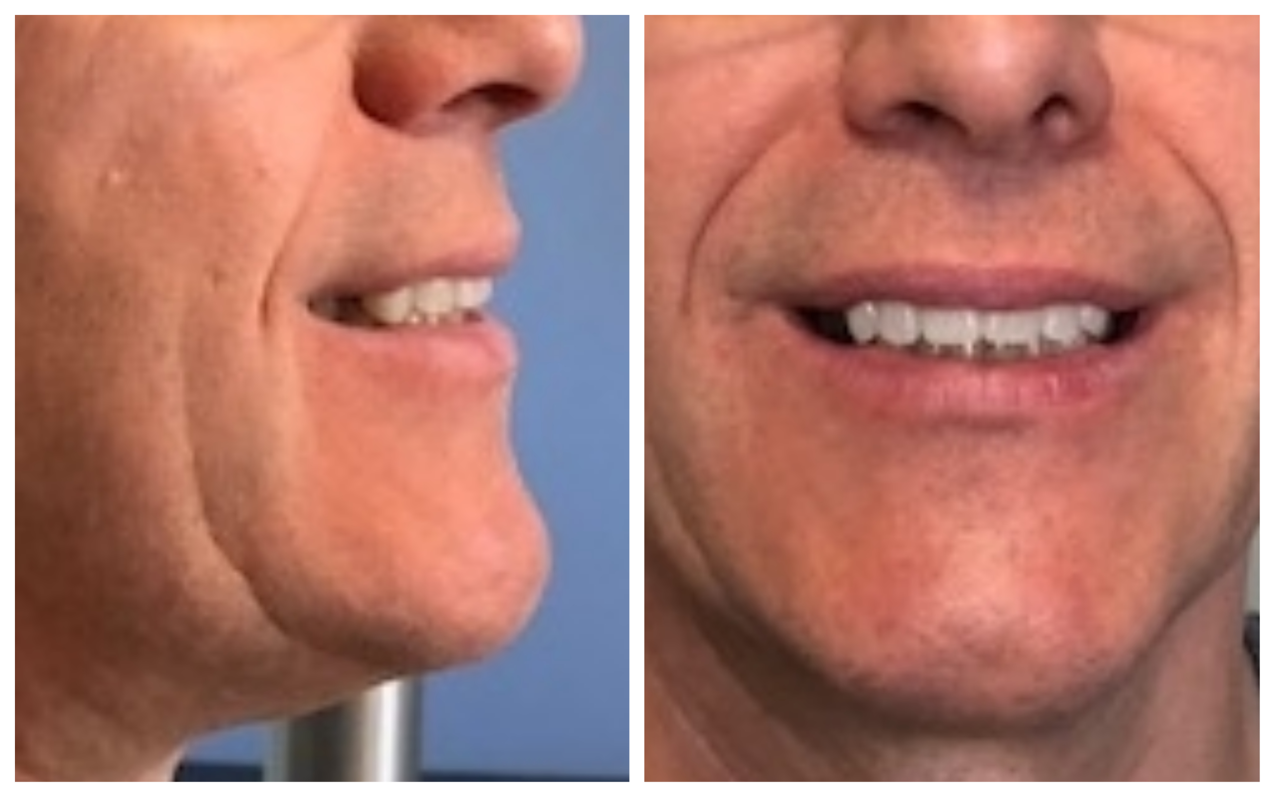 Precision Complete Upper Denture - Vernon Denture Clinic