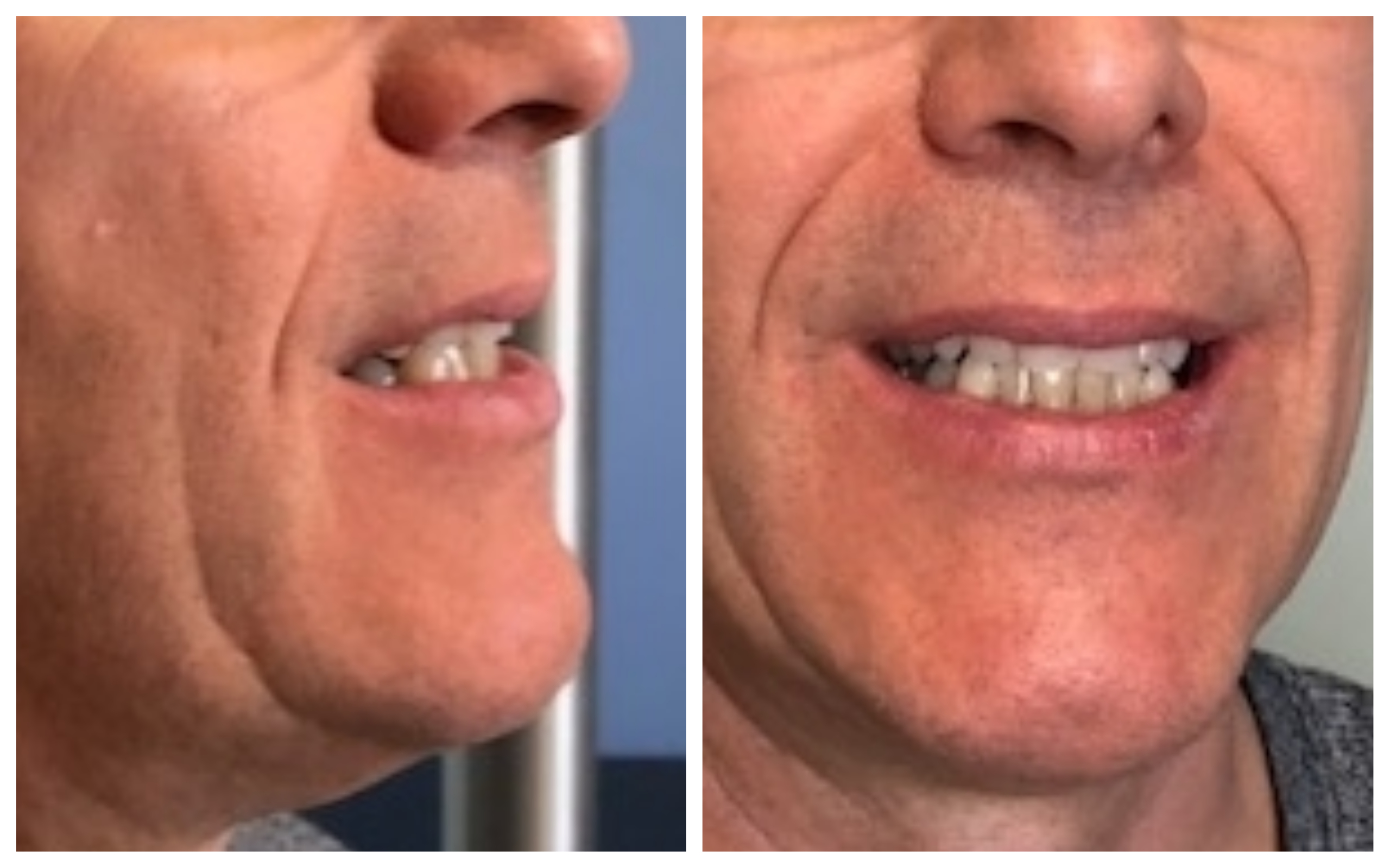 Precision Complete Upper Denture - Vernon Denture Clinic